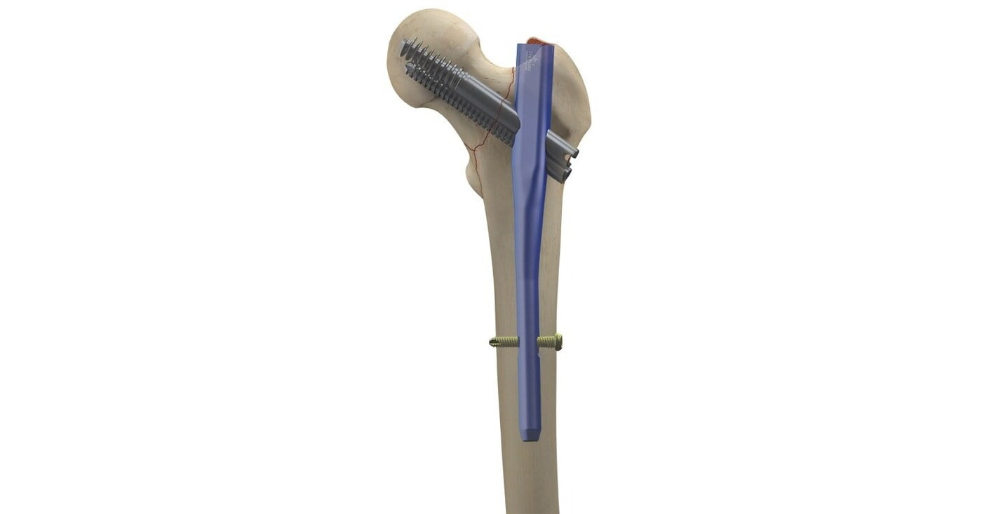 Meril™ PFIN - Advanced Proximal Femur Integrated Nail for Hip Fracture ...